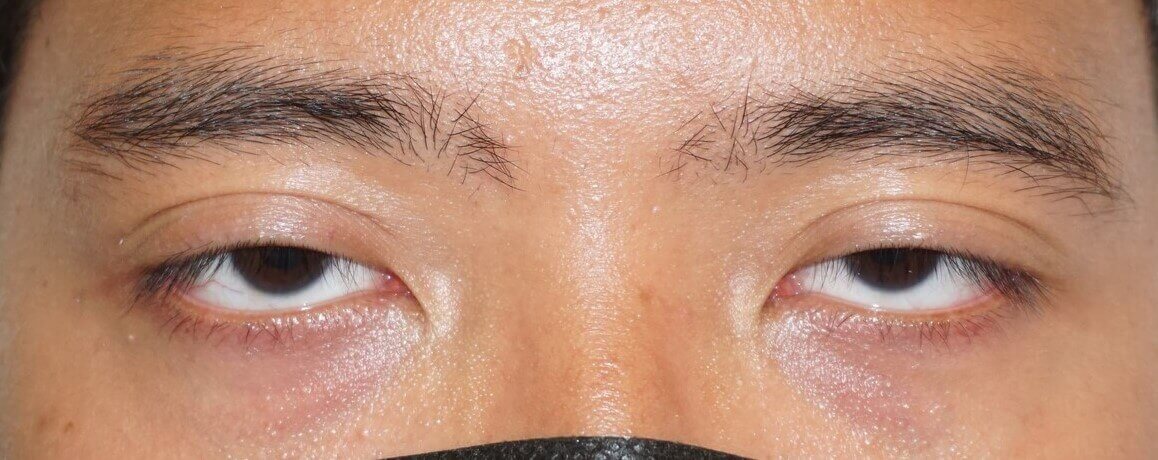Ptosis Surgery & Droopy Eyelid Correction: From $7,500
