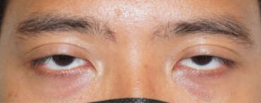 4 Benefits Of Undergoing Ptosis Correction Surgery