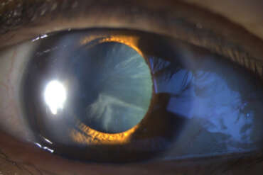 Cataracts: What They Are, Causes, Symptoms & Treatment Options