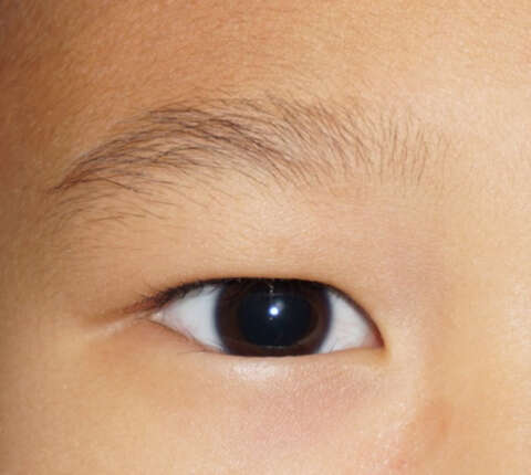 Eyelid Surgery in Children: Understanding Ptosis & Epiblepharon