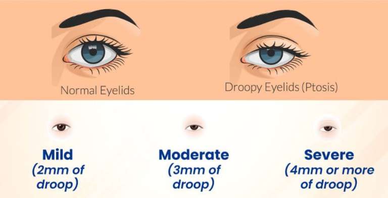 A Comprehensive Guide To Ptosis Surgery In Singapore